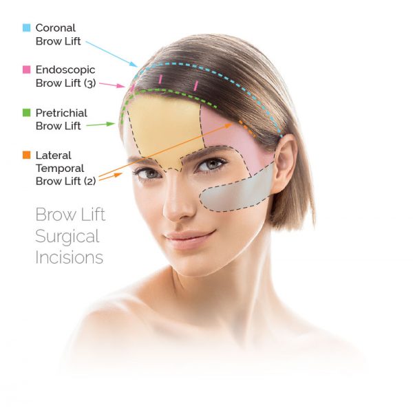 Brow Lift in Honolulu, Hawaii