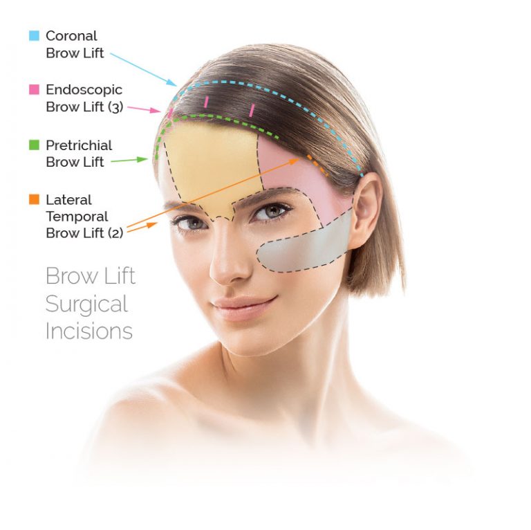 Brow Lift in Honolulu, Hawaii